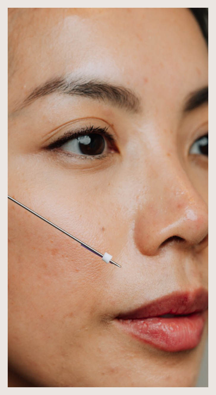 PDO Thread Lift - Scottsdale, AZ - Curated Medical